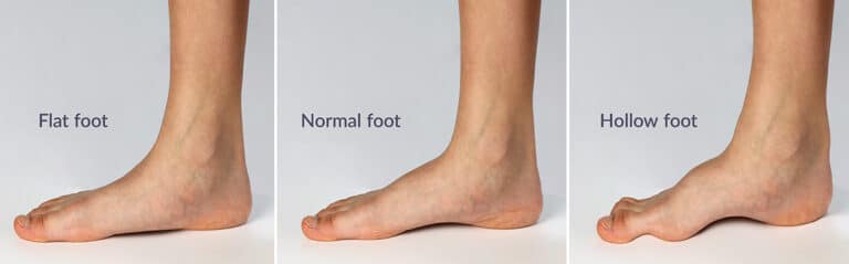 Hindfoot Conditions - When is Surgery Needed? - Martin Klinke | London ...