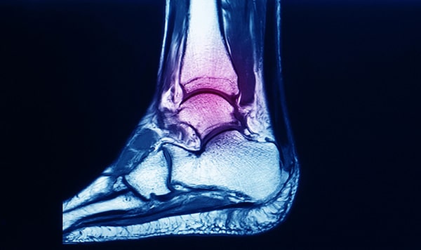 Hindfoot Conditions - When is Surgery Needed? - Martin Klinke | London ...