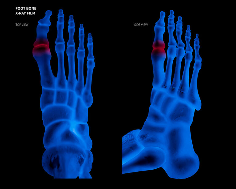 Understanding the Difference Between a Bunion and Big Toe Arthritis ...